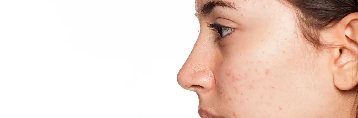 Zastosowanie preparatu Dionelle® przy leczeniu trądziku - Forum ...