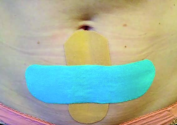 Zastosowanie kinesiotapingu w terapii chronicznego bólu menstruacyjnego ...