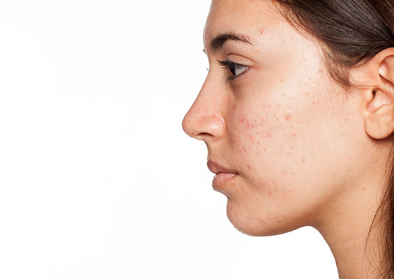 Zastosowanie preparatu Dionelle® przy leczeniu trądziku - Forum ...